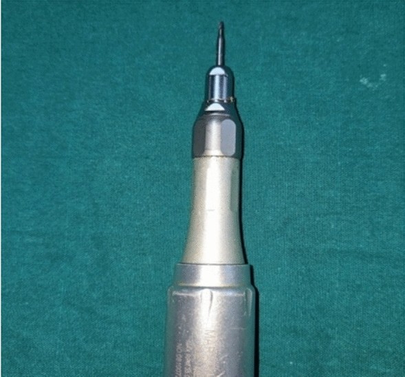 Sadhwani Technique: A Simple and Innovative Method for Retrieving ...