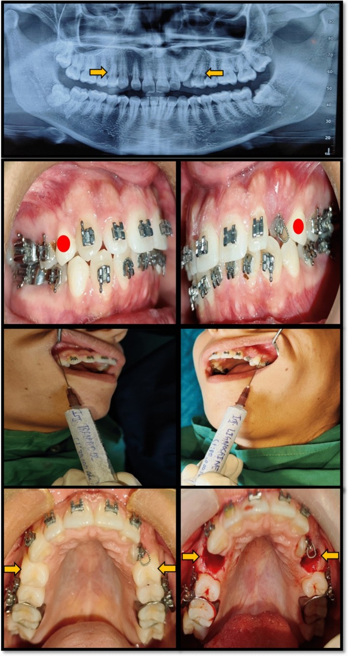 Does Tramadol Match Lignocaine for Maxillary Tooth Extraction Under ...