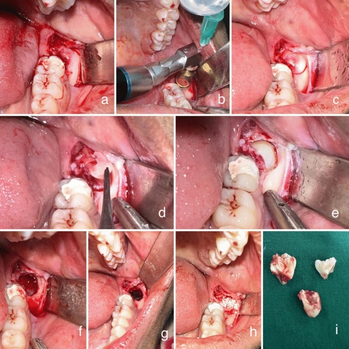 An Innovative Keyhole Trephine Technique for Deep-Seated Impacted ...