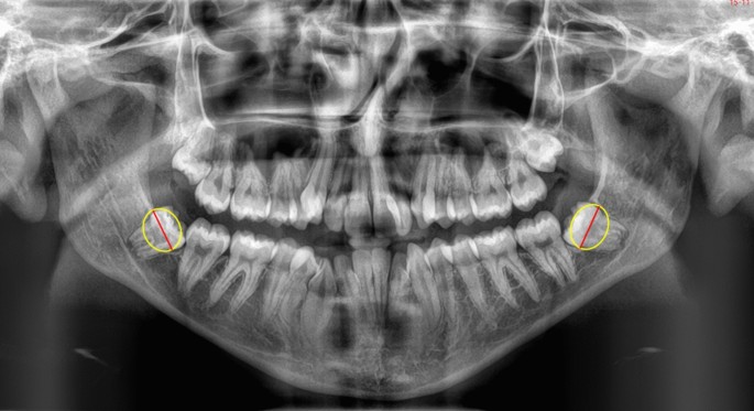An Innovative Keyhole Trephine Technique for Deep-Seated Impacted ...