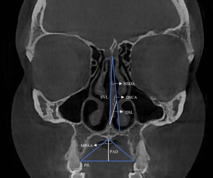 Nasal Septum And Maxillary Sinus Volume Effects On Palatal Arch: A Cbct ...