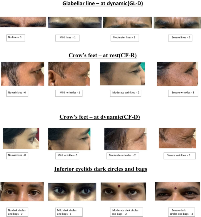 Age Estimation with Facial Changes: Validation of Photo-Numerical Scale ...