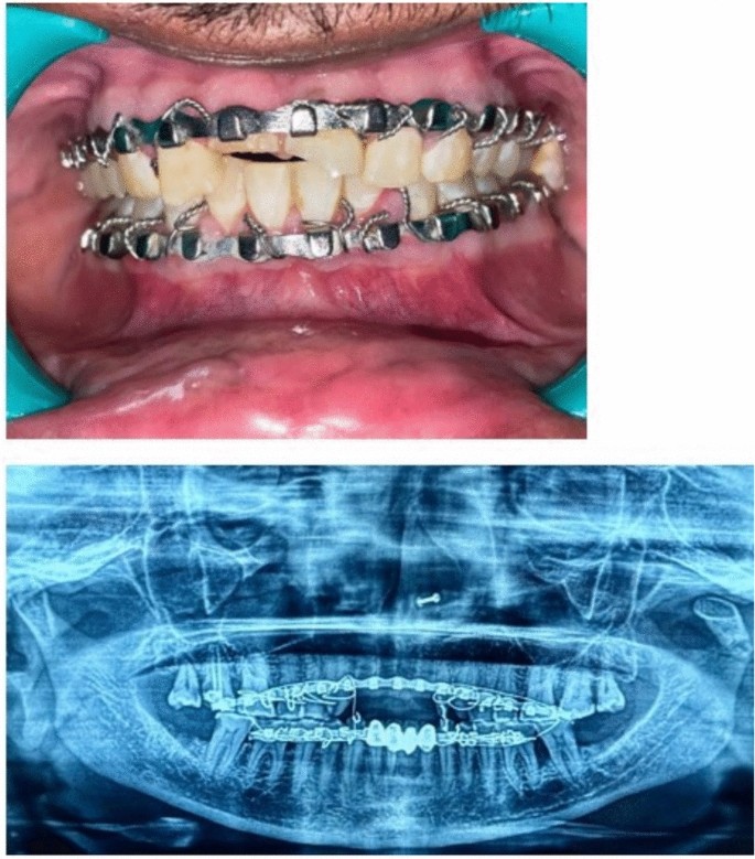 Comparative Evaluation of Erich Arch Bars with Hybrid Arch Bars for ...