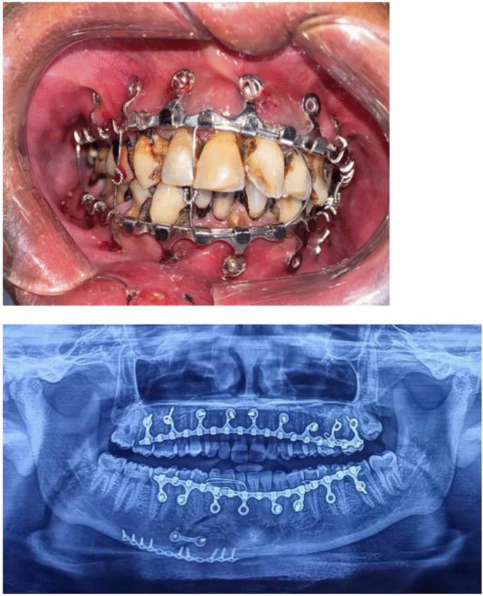 Comparative Evaluation of Erich Arch Bars with Hybrid Arch Bars for ...