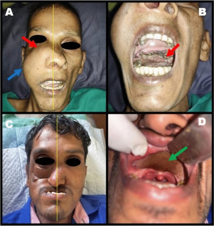 Uncommon Case of Myoepithelial Carcinoma in the Hard Palate: Diagnostic ...