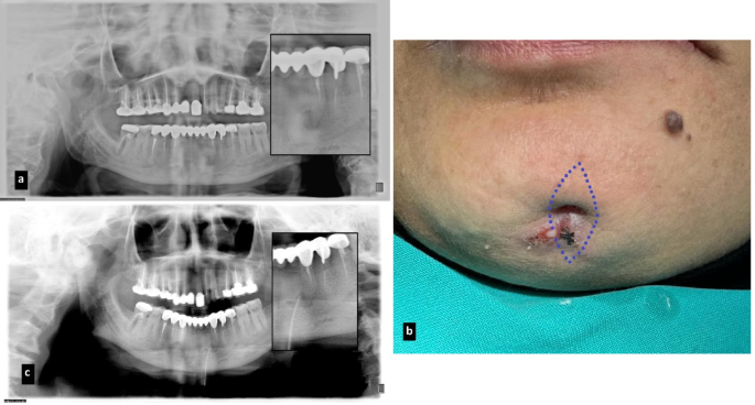 Cutaneous Sinus Tract of Odontogenic Origin: A Case Report with an ...