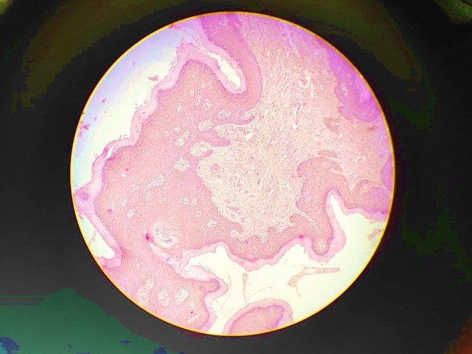 Condyloma Acuminatum of Oral Mucosa: A Rare Manifestation of Human ...