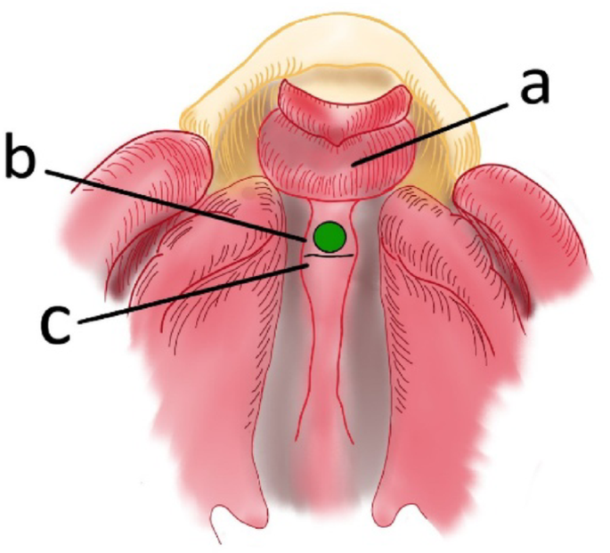 Management of Protruded Premaxilla in Bilateral Complete Cleft Lip and ...