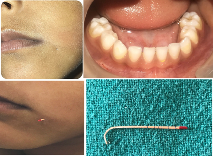 A Rare Congenital, Non-odontogenic Cheek Fistula in a Paediatric ...