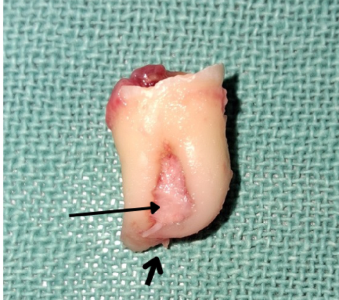 Third Molar Extraction – Tackling the Bony Bridge Dilemma: A Technical ...