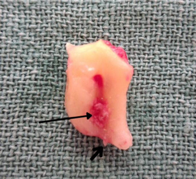 Third Molar Extraction – Tackling the Bony Bridge Dilemma: A Technical ...