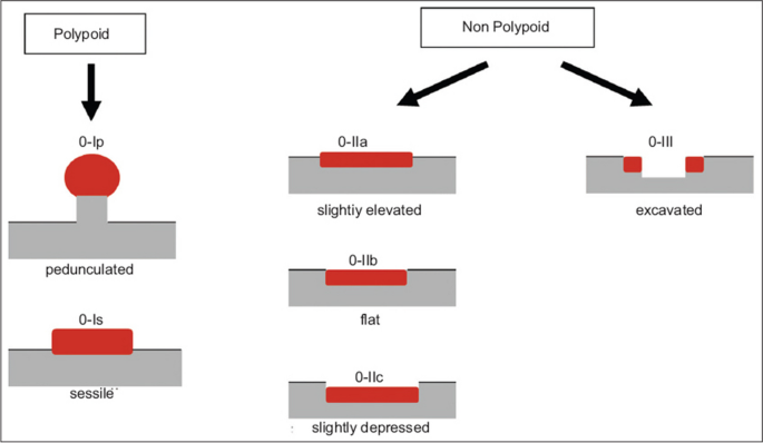 Imaging colonic polyps in 2024 | Indian Journal of Gastroenterology