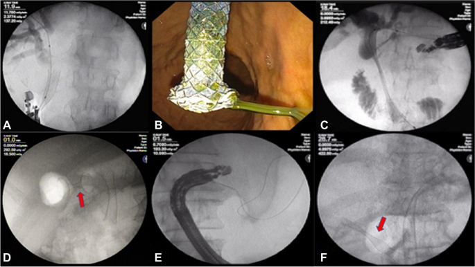 Endoscopic ultrasound-guided biliary interventions | Indian Journal of ...