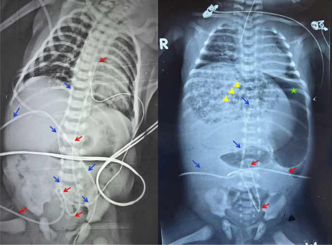 Hyperperfusion liver injury due to a malpositioned umbilical venous ...