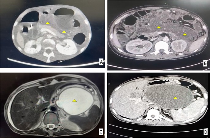 Endoscopic interventions for managing pancreatic fluid collections ...