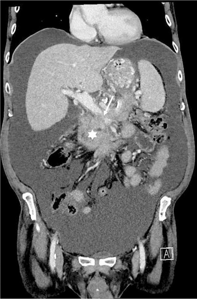 Transjugular intra-hepatic approach for portal vein stenting in post ...