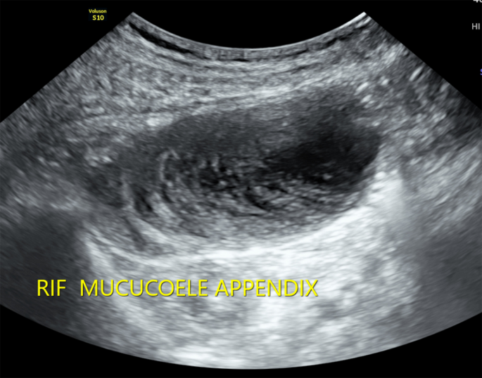 Onion skin sign of mucocele of the appendix—A rare entity | Indian ...