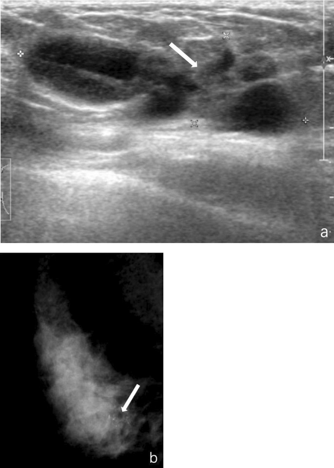 Clinical and imaging characteristics of intraductal papillary neoplasms ...