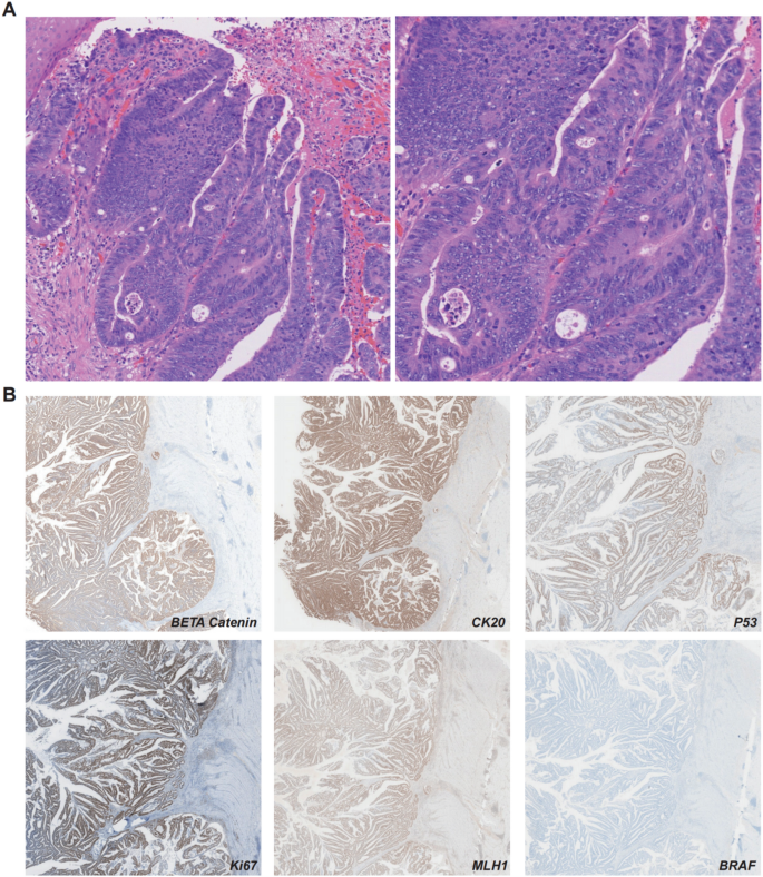 A rare case of primary transverse colon adenocarcinoma penetrating the ...