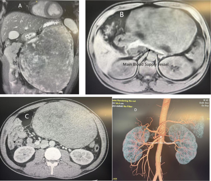 Doege-Potter syndrome in a patient with solitary fibrous tumor of the ...