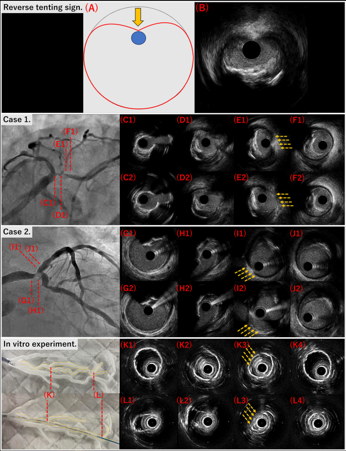 A novel finding for predicting heightened risk for vessel injury caused ...