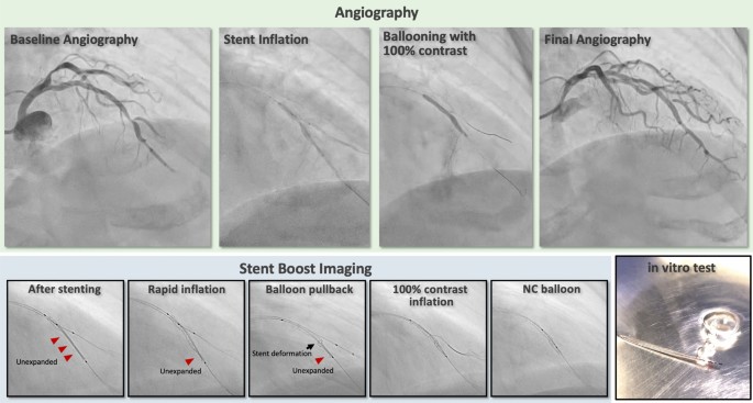 Effective management of pinhole rupture in stent mount balloon during ...