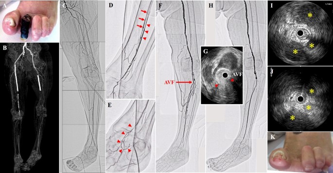Successful two-stage revascularization by securing a temporary distal ...