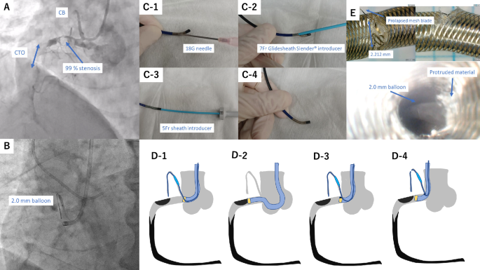Treatment of right coronary artery occlusion using the side-hole anchor ...