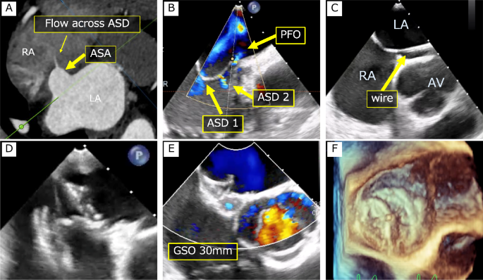 Folding atrial septal aneurysm to close multi-fenestrated ASDs and a ...