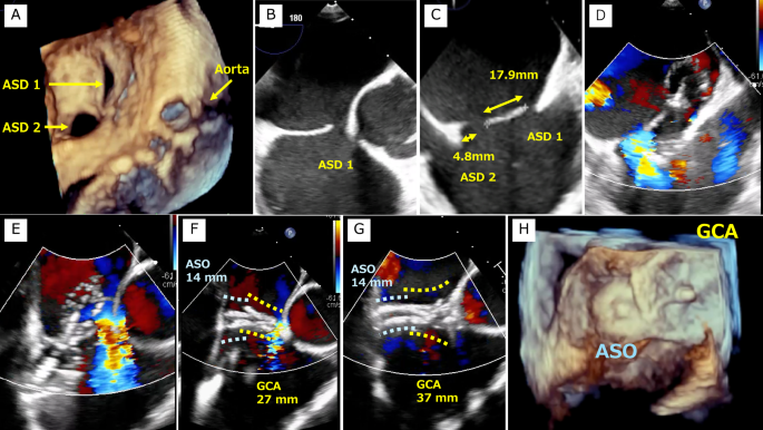 Dual-device closure of separate atrial septal defects with amplatzer ...