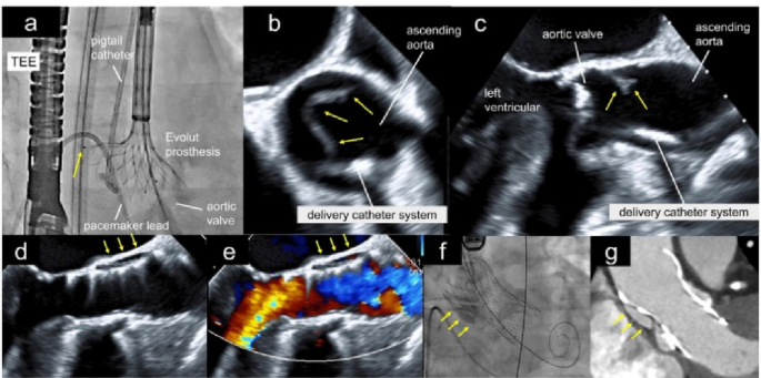 A novel mechanism of iatrogenic aortic dissection: interference between ...