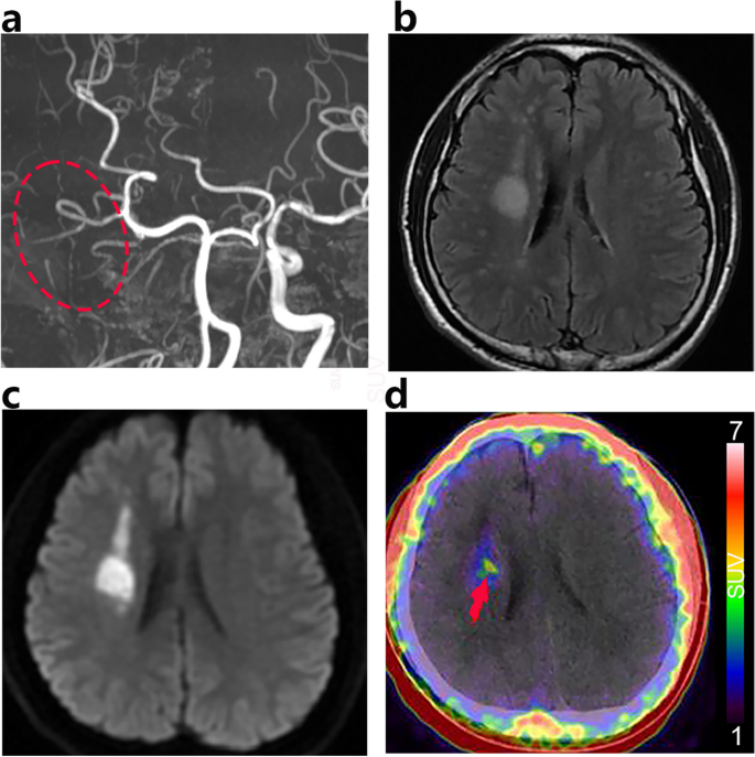 Cerebral [18F]AIF-FAPI-42-Based PET Imaging of Fibroblast Activation ...