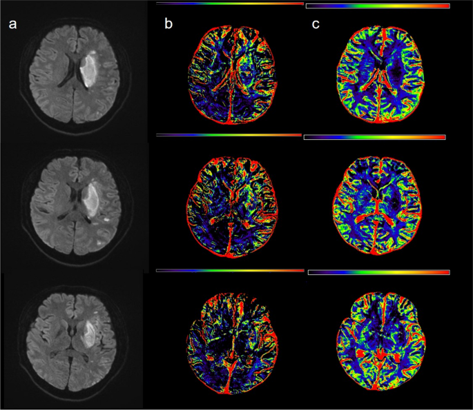 Blood–Brain Barrier Disruption and Imaging Assessment in Stroke ...