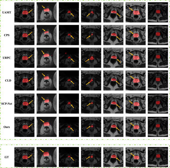 Dual perturbation consistency learning for semi-supervised medical image segmentation ...