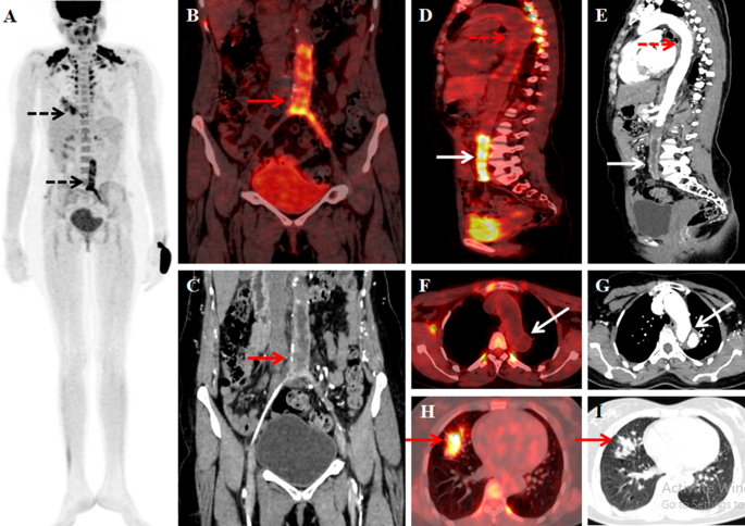 Inverted Y Sign: Infected Aortic Graft Thrombosis in a Patient with ...