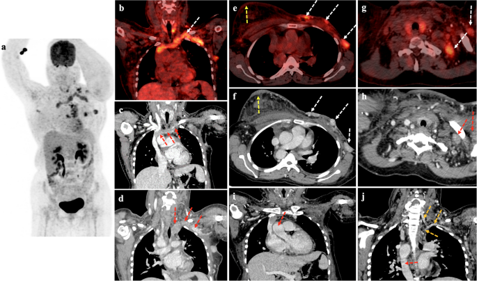 “Snake in the Orchard” Sign on 18F-FDG PET/CT: A Rare Presentation of ...