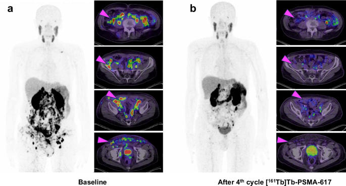 Auger Emitting [161Tb]Tb-PSMA-617 Radioligand Therapy in mCRPC with ...