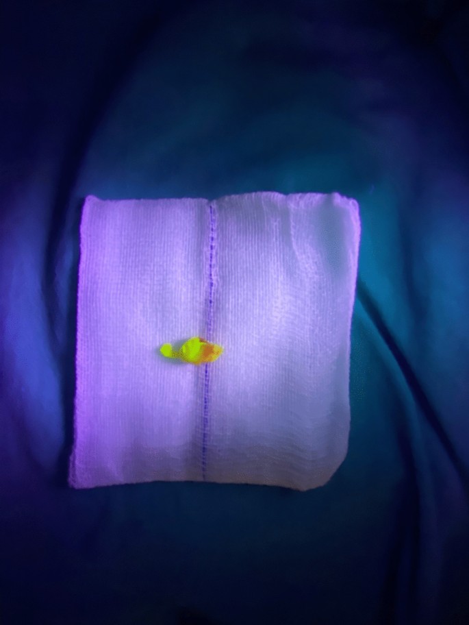 Combined Fluorescein and Methylene Blue Dye for Sentinel Lymph Node ...