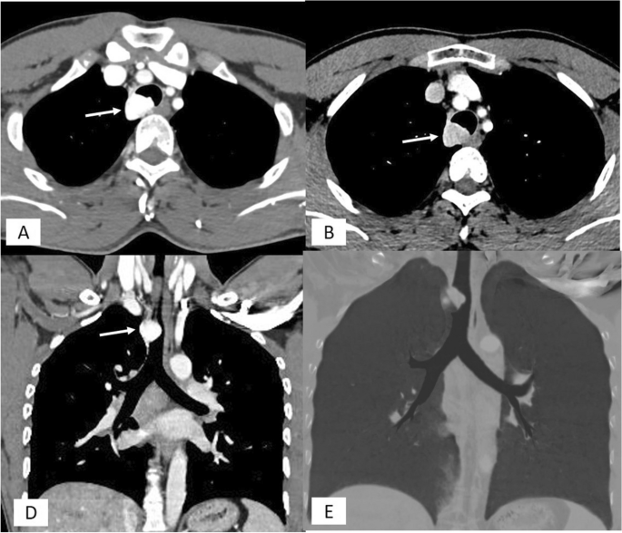 Tracheal Paraganglioma: Journey Through the Airways Using CT and CT ...