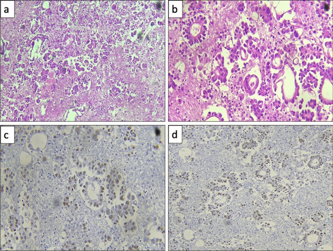 Immunohistochemistry Markers in Ovarian and Fallopian Tube Neoplasms: a ...
