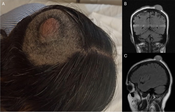 Scalp Metastasis from Caval Leiomyosarcoma: an Unusual Site of ...