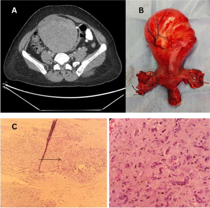 Neoplasm within Neoplasm—A Rare Case of Breast Carcinoma with Isolated ...