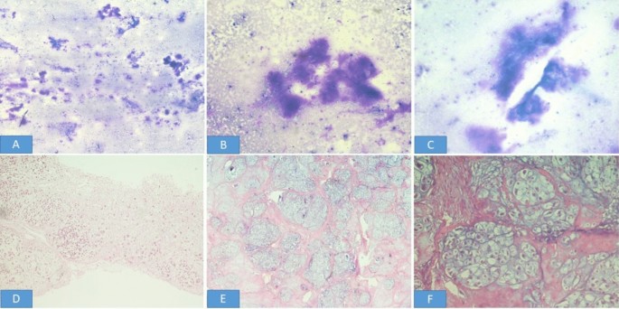 Primary Chondrosarcoma of the Breast: A Diagnostic and Histopathologic ...