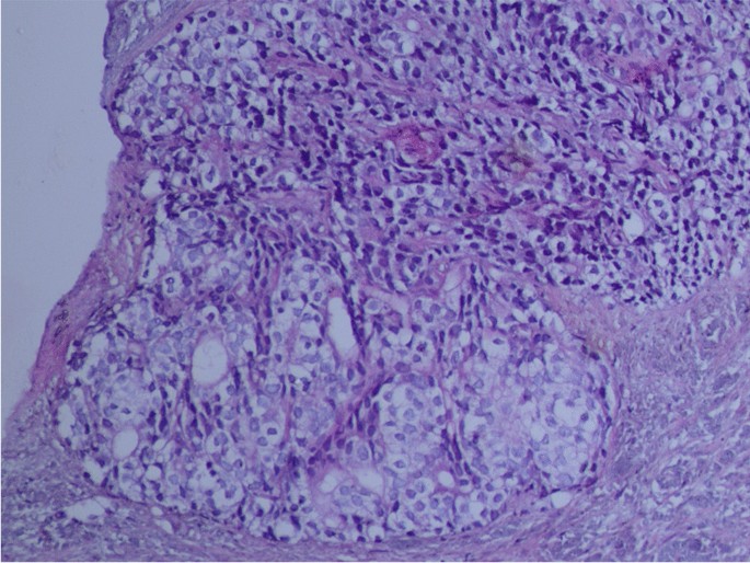 Comparison of Gleason Scoring—2005 and 2014 Updates | Indian Journal of ...