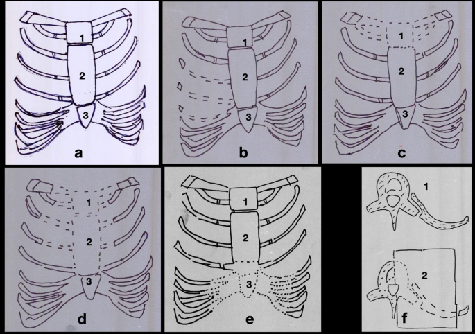 Neo-Rib Technique of Chest Wall Reconstruction Following Oncological ...