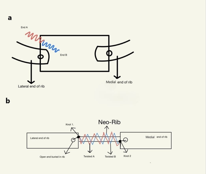 Neo-Rib Technique of Chest Wall Reconstruction Following Oncological ...