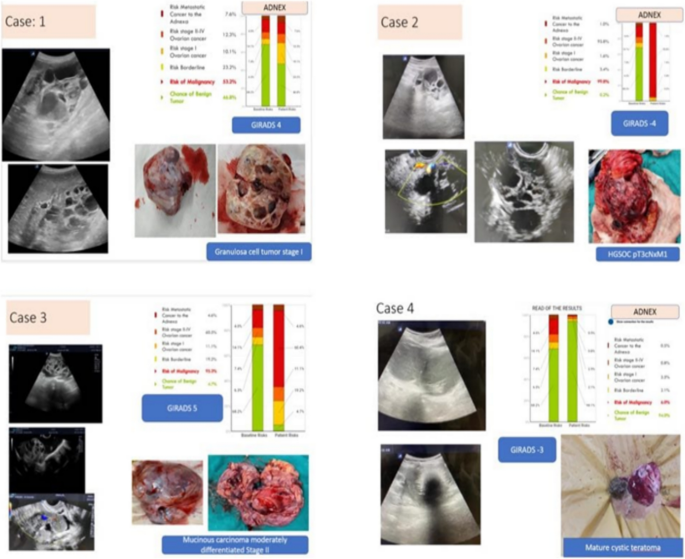Comparison of ADNEX Model with GI-RADS Ultrasound Scoring System in Evaluation of Adnexal Mass ...