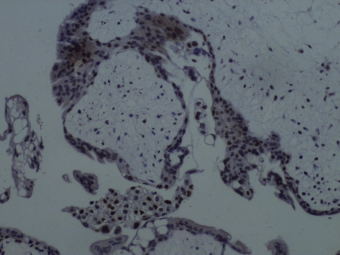 Immunohistochemical Staining: Prognostic Marker of Malignant ...