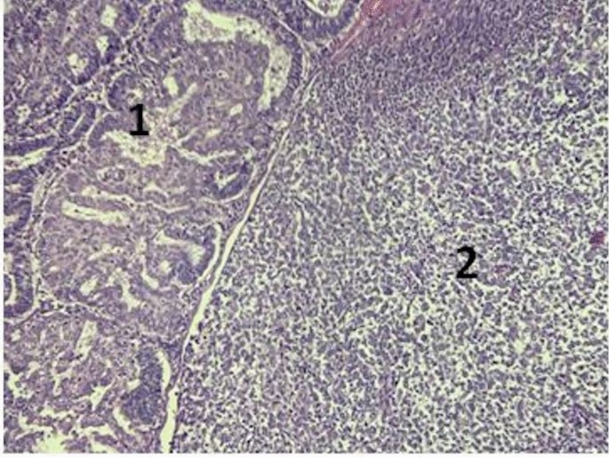 Case Report on Dedifferentiated Carcinoma of Endometrium and It’s ...
