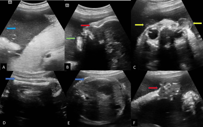 Prenatal Ultrasound Diagnosis of Harlequin Ichthyosis | The Journal of ...